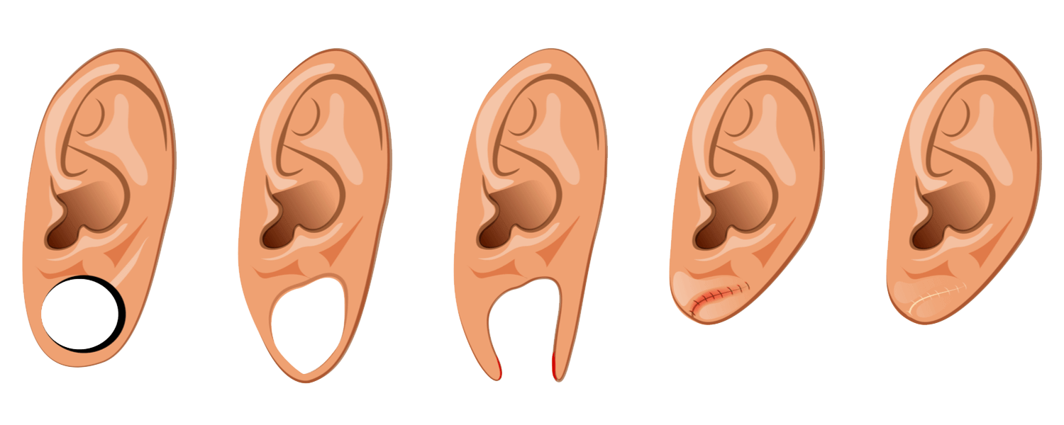 Kulak Memesi Estetiği - İstanbul - Quartz Clinique