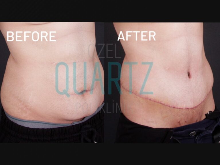 Belly Button Surgery - Price - Istanbul, Turkey - Quartz Clinique