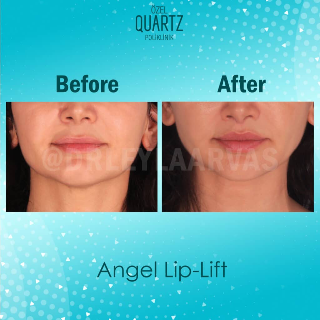 Lip Lift Surgery - Price - Istanbul, Turkey | Quartz Clinique