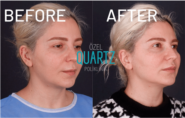 Buccal Fat Removal - Bichectomy - Price - Istanbul, Turkey - Quartz ...