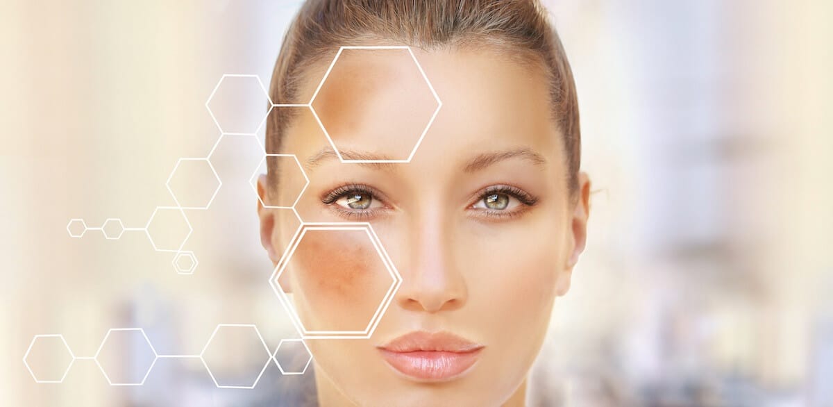 Melasma Treatment - Price - Istanbul, Turkey | Quartz Clinique