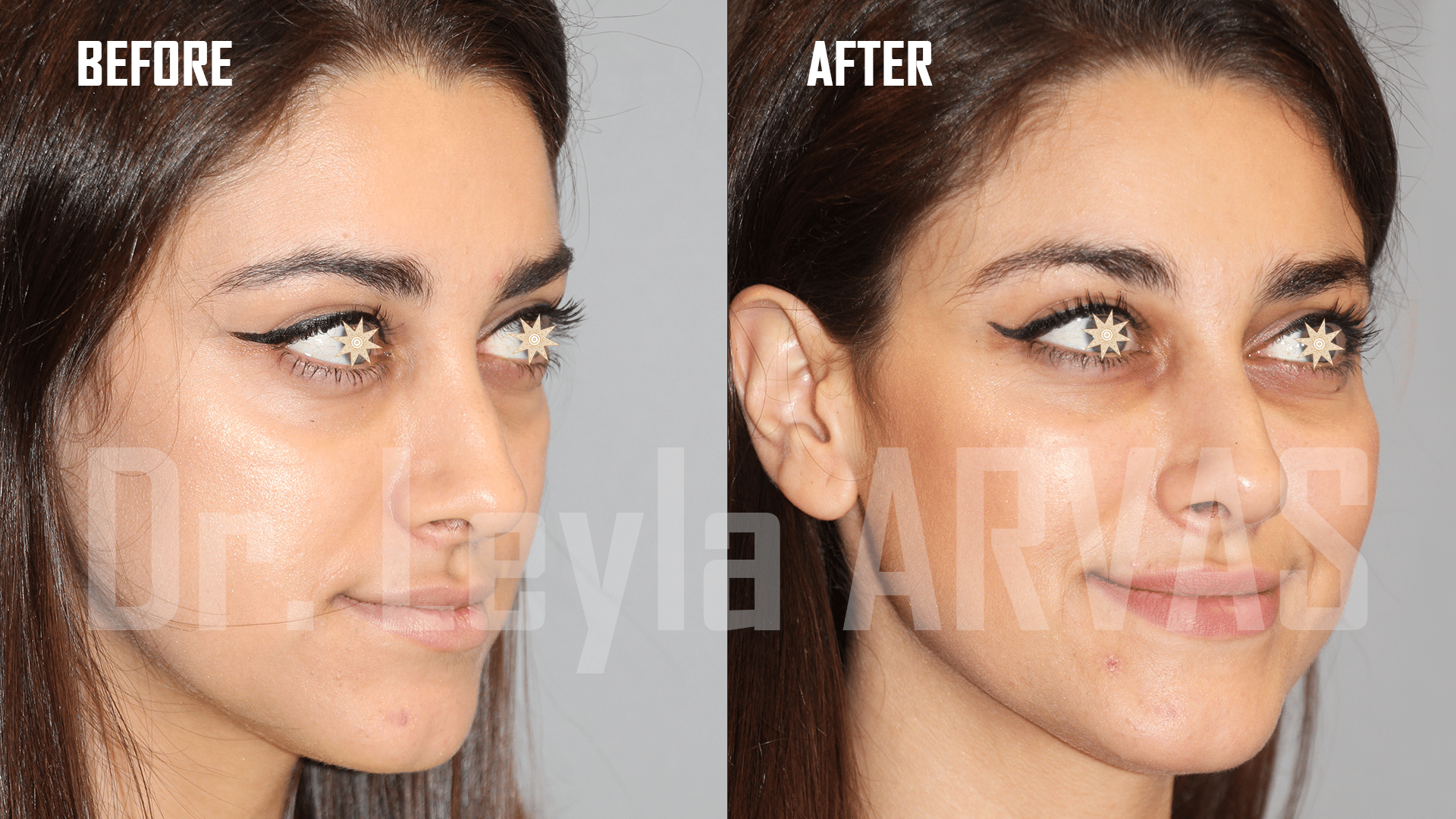 Cheek Filler - Price - Istanbul, Turkey - Quartz Clinique
