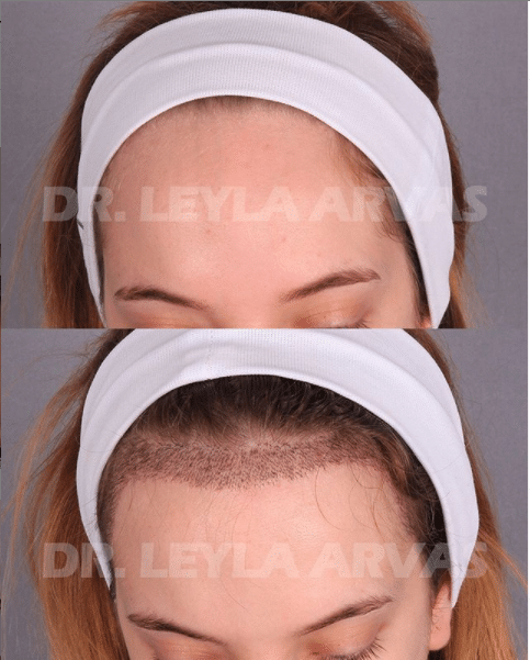 Réduction du Front par Abaissement de la Ligne Frontale | Prix 2025 ...