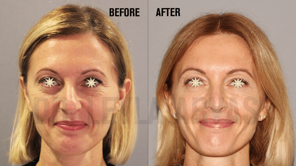 Augenringe Filler - Kosten- Istanbul,Türkei- Quartz Clinique