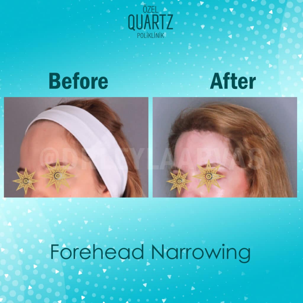 Forehead Reduction Surgery - Price - Istanbul, Turkey | Quartz Clinique