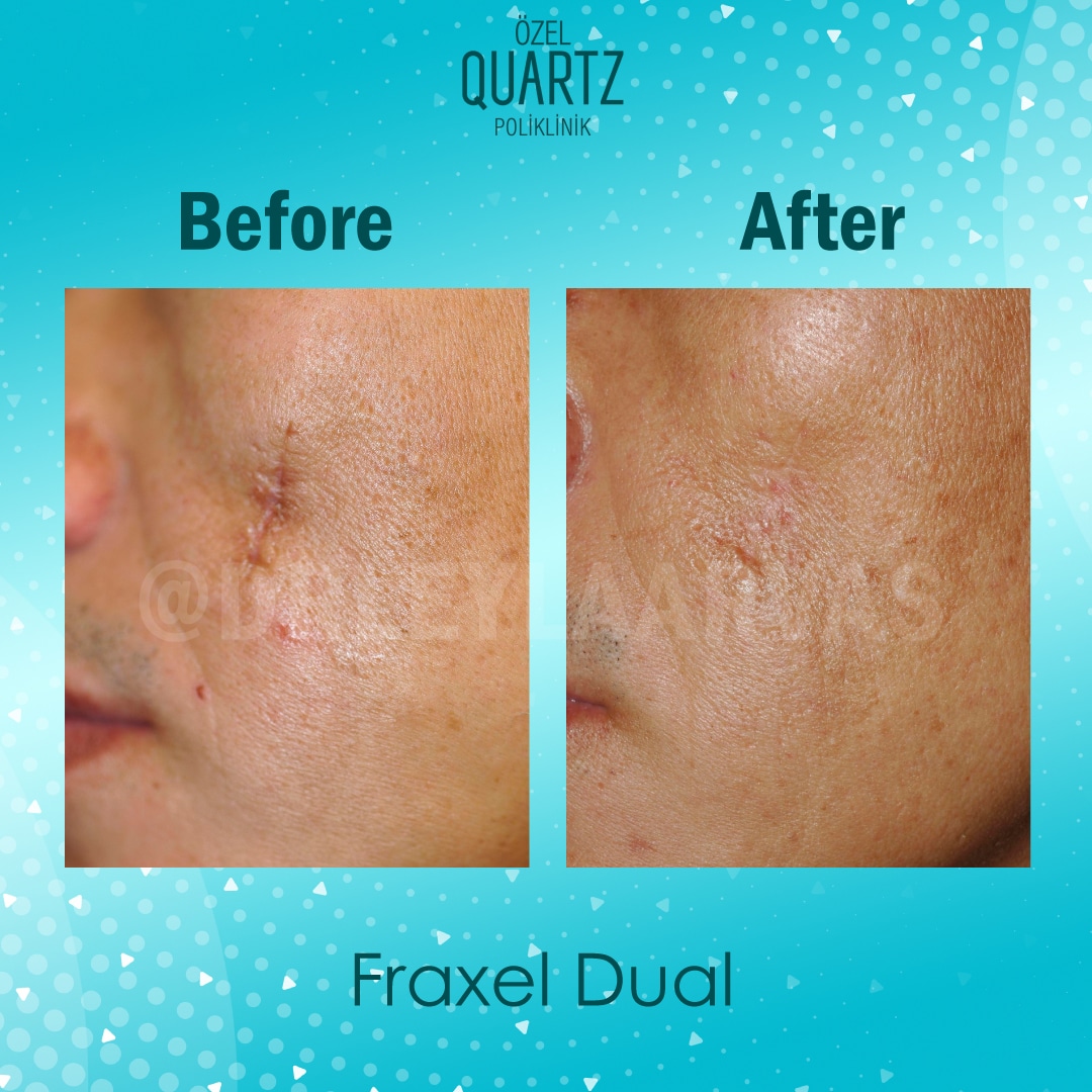 Fraxel-Laser-Behandlung - Kosten- Istanbul,Türkei- Quartz Clinique