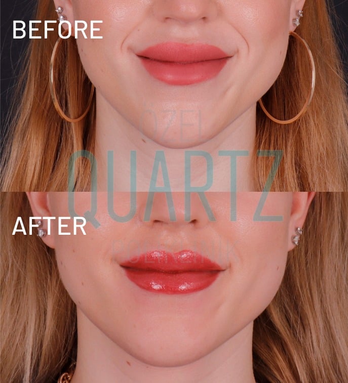 Comblement du Sillon Nasogénien | Prix 2025 | Quartz Clinique